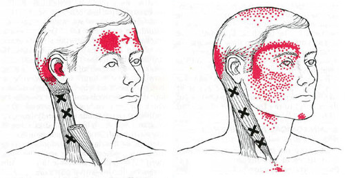 Triggerpointtherapie | INEVA total body